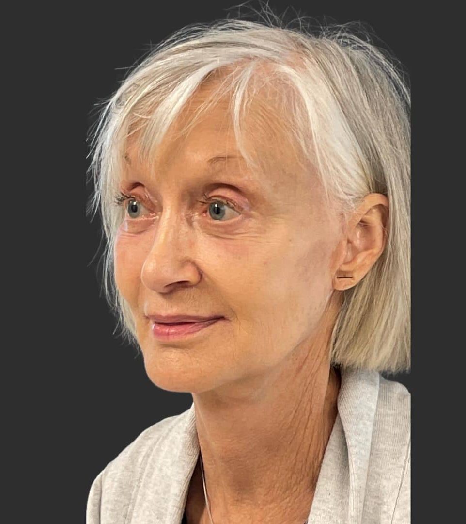 Brow Lift - TOC Eye and Face