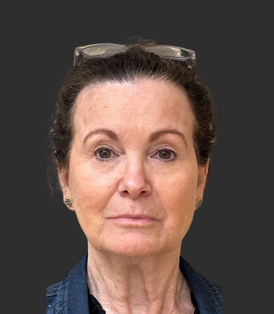 Lower Blepharoplasty - TOC Eye and Face