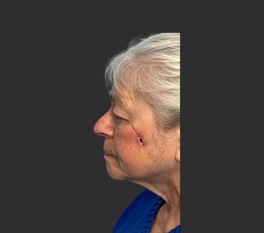 Scar Revision - TOC Eye and Face