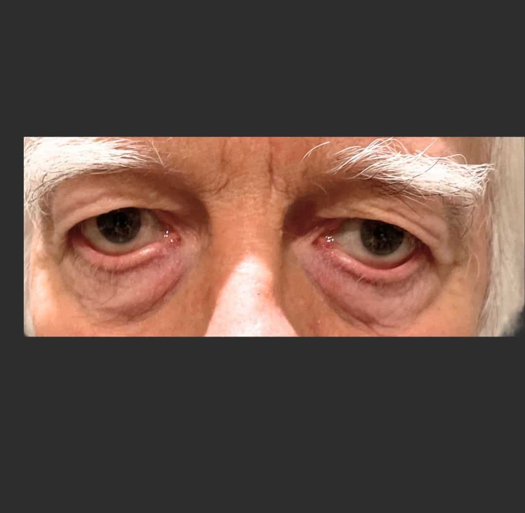 Ectropion (Eyelid Turning Out) - TOC Eye and Face