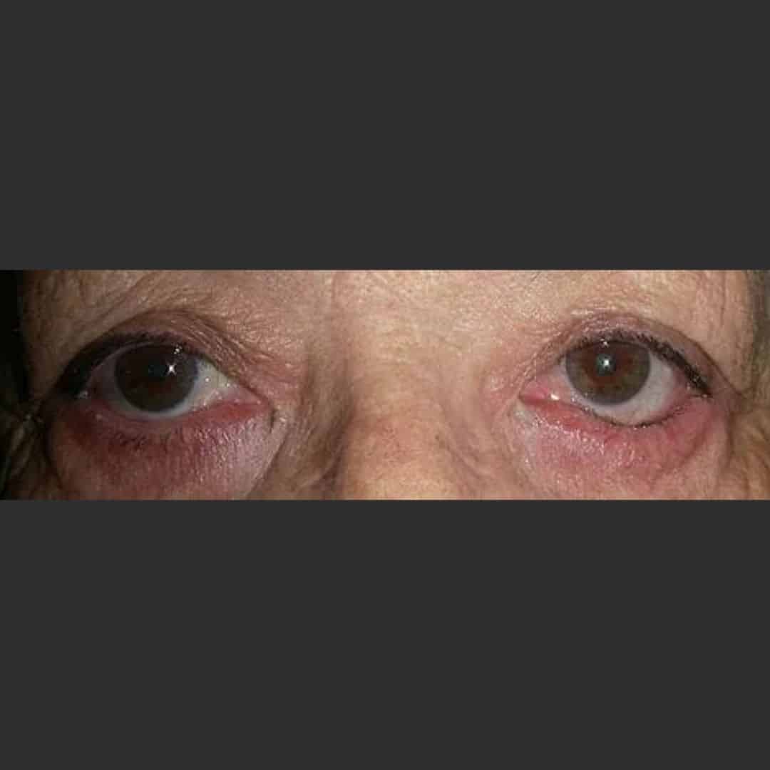 Entropion (Eyelid Turning In) - TOC Eye and Face