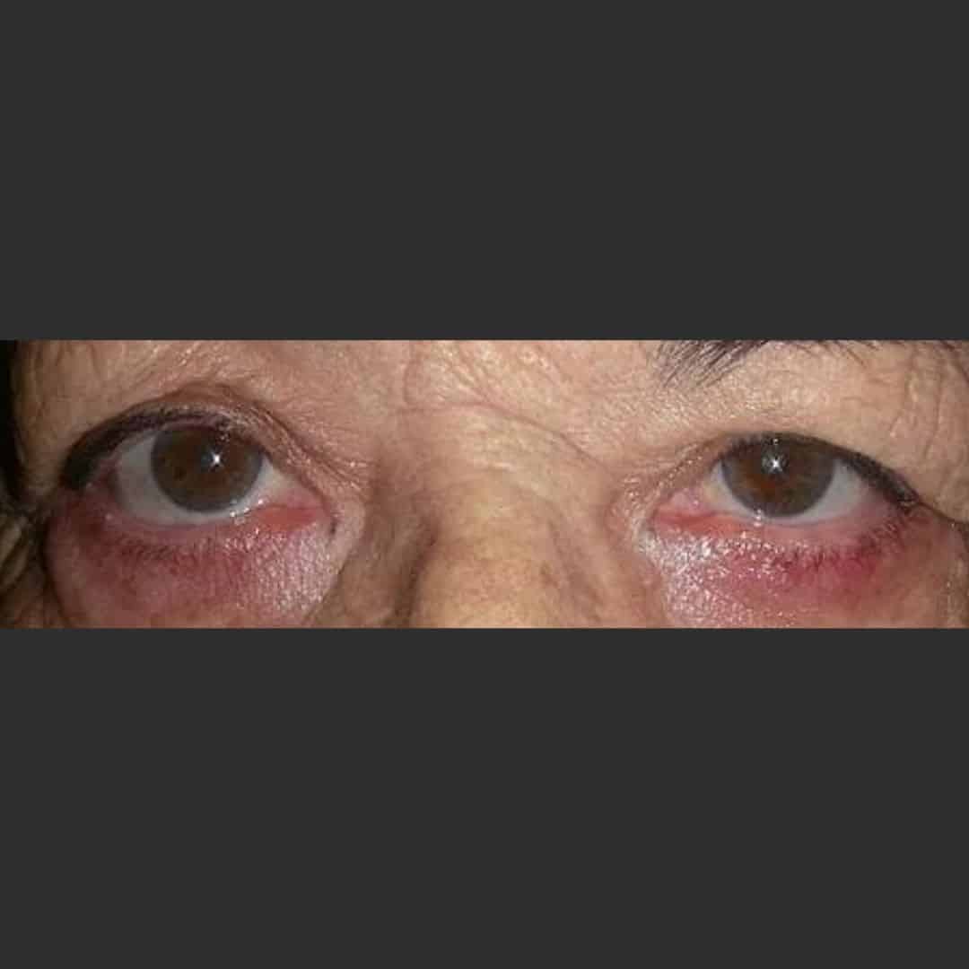 Entropion (Eyelid Turning In) - TOC Eye and Face
